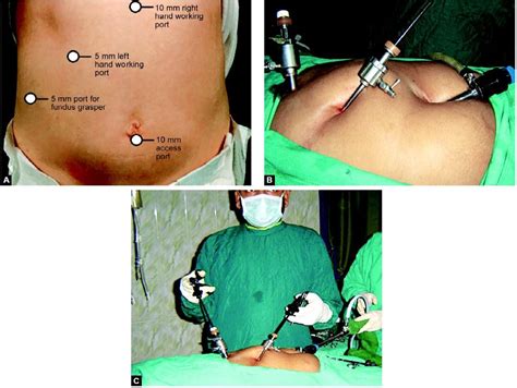 Laparoscopic Cholecystectomy Steps