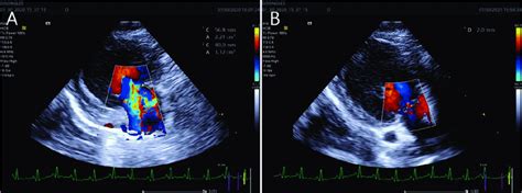 A Semi Quantification Of Mitral Regurgitation Mr The Maximal Ratio