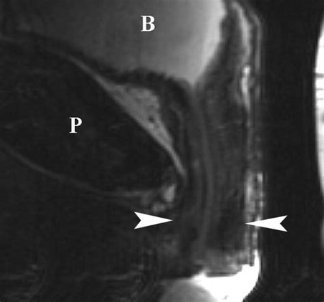 Mr Imaging Of The Female Urethra And Supporting Ligaments In Assessment