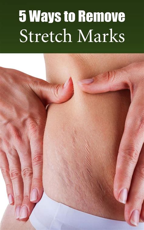 5 Ways To Remove Stretch Marks Naturally Stretch Marks Natural And