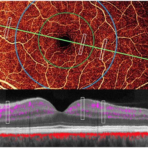Cross Sectional Capillary Density Map In The Retina Of A Normal Human