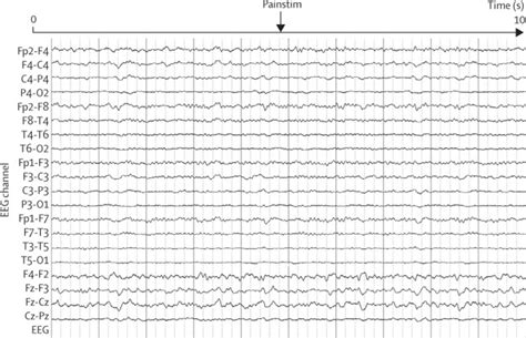 Neurological Prognostication Of Outcome In Patients In Coma After