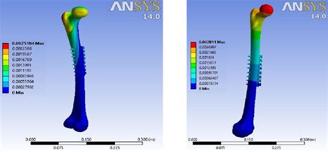 [pdf] Finite Element Analysis Of Femur Fracture Fixation Plates