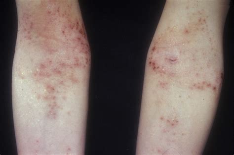 Atopic Dermatitis Medicine