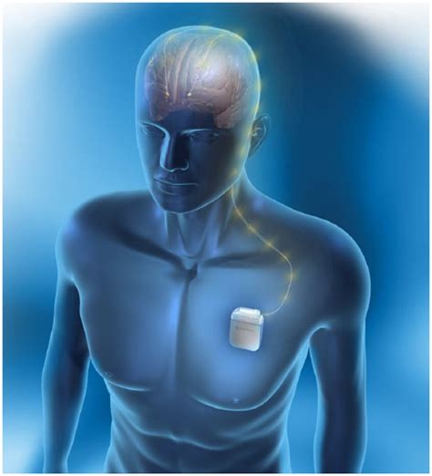 Deep Brain Stimulation An Overview Of History Methods And Future