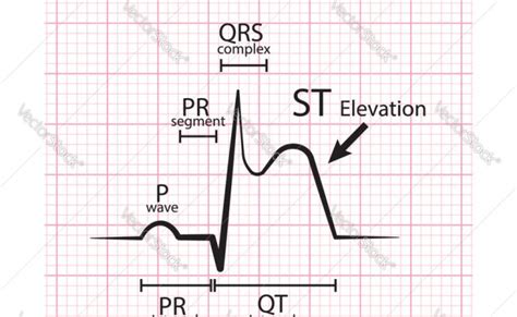 St Elevations Monitoring For Infarction Stemi Electrocardiogram Ecg Ekg