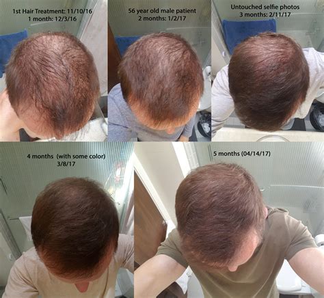 Acell Prp Hair Regrowth Therapy Serenity Medspa