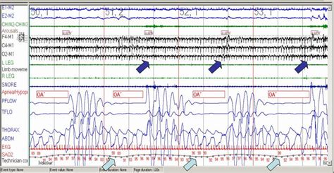 Obstructive Sleep Apnea Article