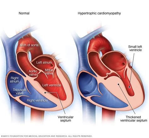 Cardiomyopathy Disease Reference Guide