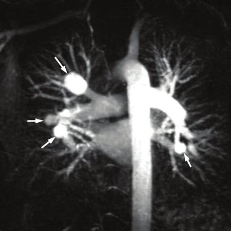 Perfusion Lung Scintigraphy With 99mtc Maa Multiple Segmental Defects