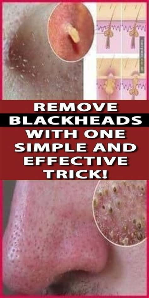 Remove Blackheads With One Simple And Effective Trick Healhty And Tips