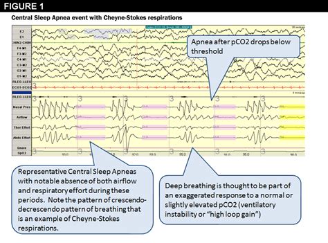 Basics Of Central Sleep Apnea American College Of Cardiology