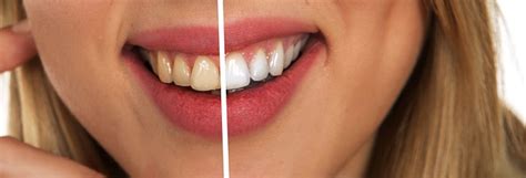 Teeth Lightening Exactly How It Functions Types And Side Effects