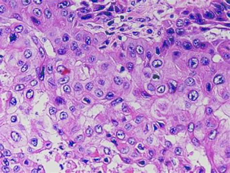 High Power Tumor Cells Are Large With Irregular Atypical