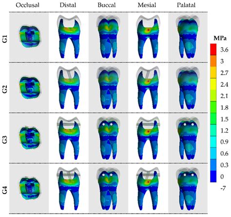 Materials Free Full Text Stress Concentration Of Endodontically