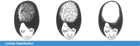 Ludwig Classification Diagnosing Female Hair Loss