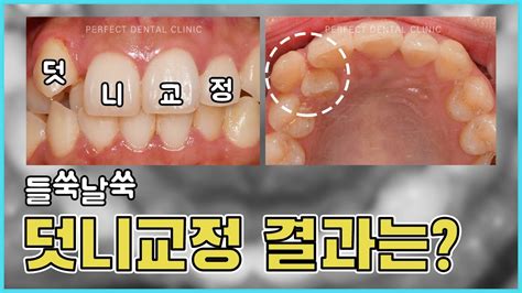 덧니 돌출입 치아교정으로 성형효과를😊 덧니교정과정 전후비교 Youtube