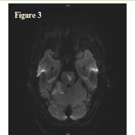 Diffusion Weighted Images On Mri Brain Showing Diffusion Restriction In