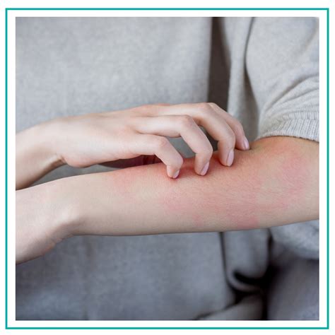 Eczema Treatment Dermatology And Skin Surgery Center Stockbridge Ga