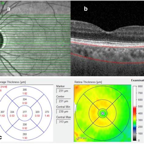 Enhanced Depth Imaging Optical Coherence Tomography Edi Oct Of The