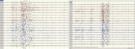 Eeg Revealed Generalized Epileptiform Discharges Download Scientific