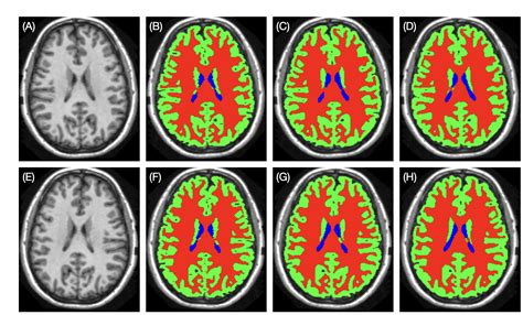 Spectra Group Equivariant Convolutional Networks In Medical Image