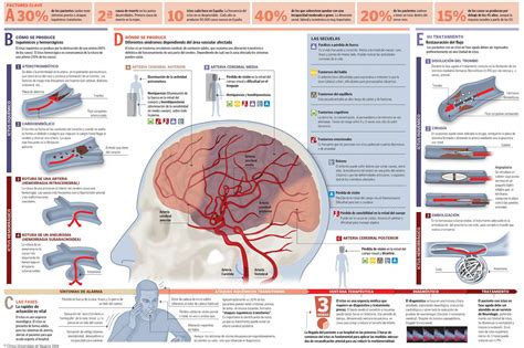 Ictus Acv Síntomas Y Tratamiento Clínica Universidad Navarra