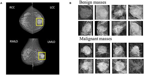 Frontiers Improving The Prediction Of Benign Or Malignant Breast