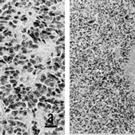 The Tumor Cells Are Arranged To Form Homer Wright Rosettes A Or