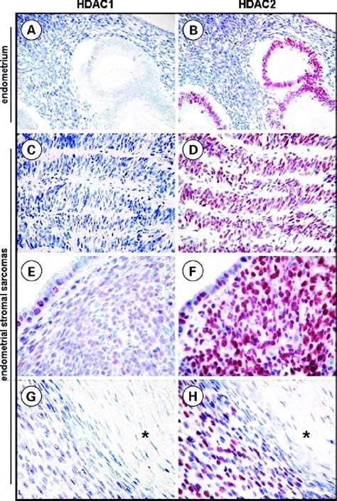 Hdac1 And Hdac2 Expression In Nonneoplastic Endometrial Stroma And In