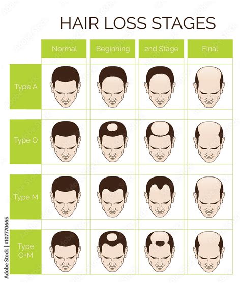 Information Chart Of Hair Loss Stages And Types Of Baldness Illustrated