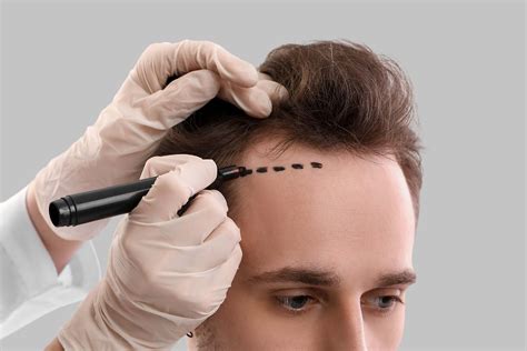 How Long After A Hair Transplant Can You Workout