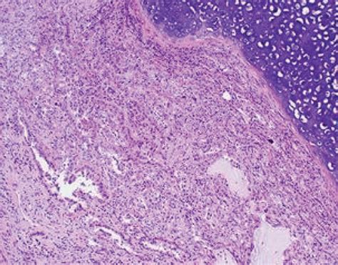 A Primitive Neuroectodermal Tumor Component Present In The Testicular