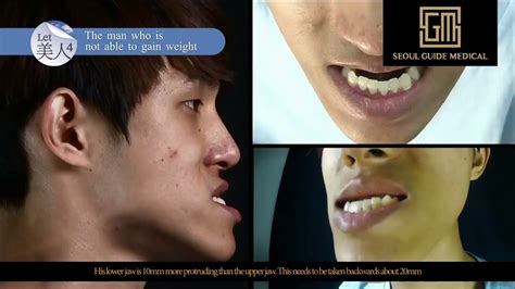 Life Altering Korean Plastic Surgery Transformation Show Seoul Guide
