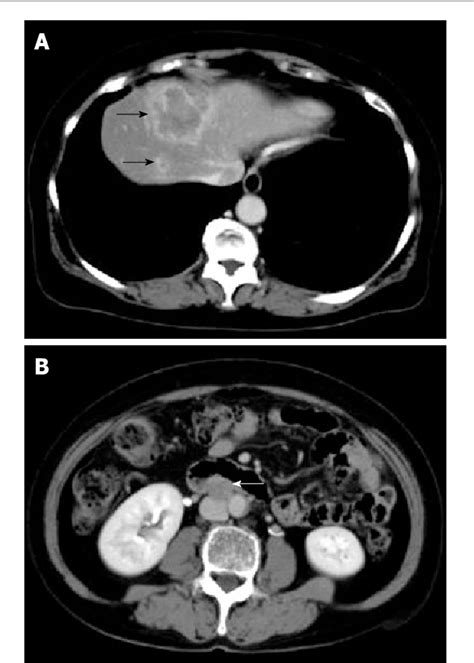 Figure 1 From A Case Of Advanced Intrahepatic Cholangiocarcinoma