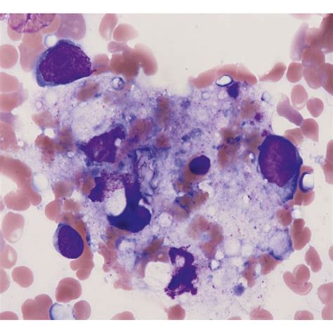 Bone Marrow Aspiration Biopsy Findings A B Bone Marrow Aspirate