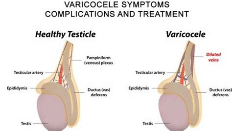 Varicocele Surgery At Rs 180000 In Nagpur Id 10900827233