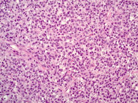 Pathology Outlines Granulosa Cell Tumor Adult