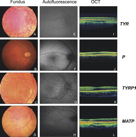 Fundus Photography Faf And Oct Analysis In Four Patients With