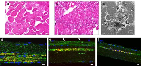 Analysis Of Muscle Biopsies From An Adult Onset Patient D9 A Hande