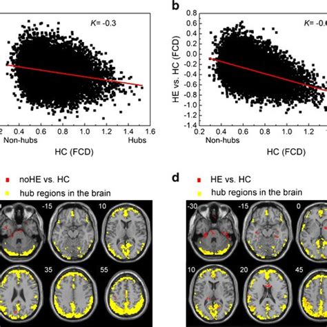 Abnormal Extent Of Functional Connectivity Density Fcd In Nohe A