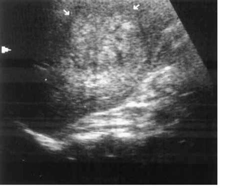 Abdominal Ultrasound Image Shows A Heterogeneous Hyperechoic Mass