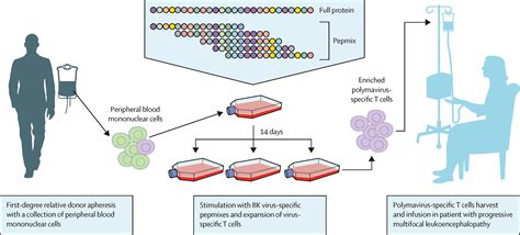Bk Virus Specific T Cells For Immunotherapy Of Progressive Multifocal