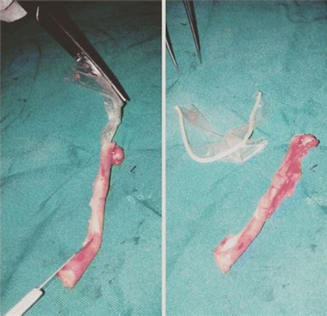woman complains of stomach ache doctors find condom inside appendix