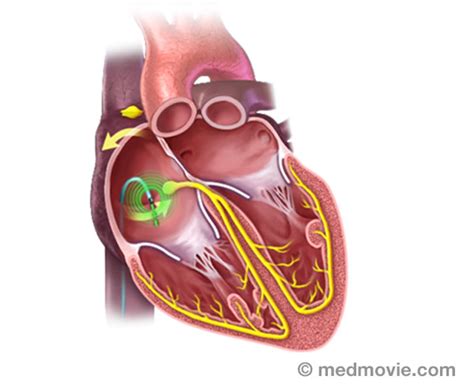 atrial flutter ablation
