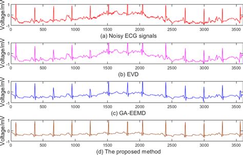 Noisy Ecg Signals And Denoised Ecg Signals By Three Methods