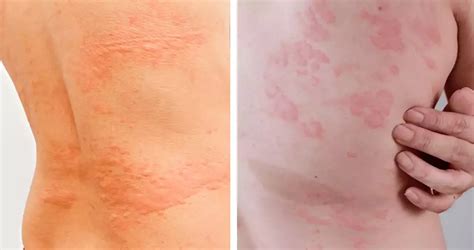 Manejo Cuidados Y Prevención De La Urticaria Agua Y Crónica