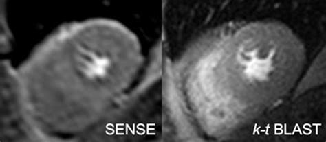 A Comparison Of High Resolution And Standard Cardiovascular Magnetic