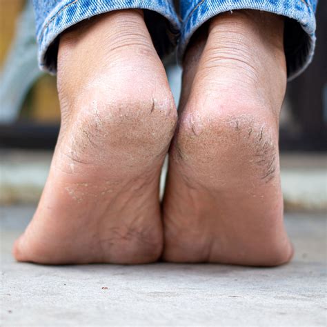 Heal Your Dry Cracked Heels Syracuse Podiatry Dr Ryan Damico