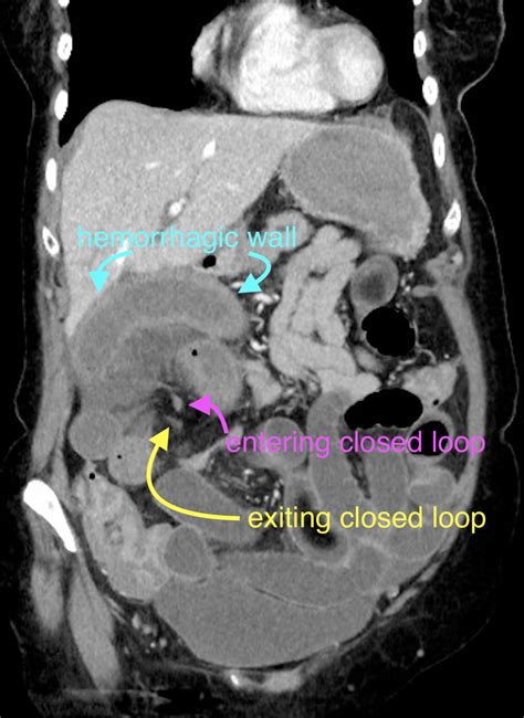 File Closed Loop Small Bowel Obstruction Due To Adhesive Band With